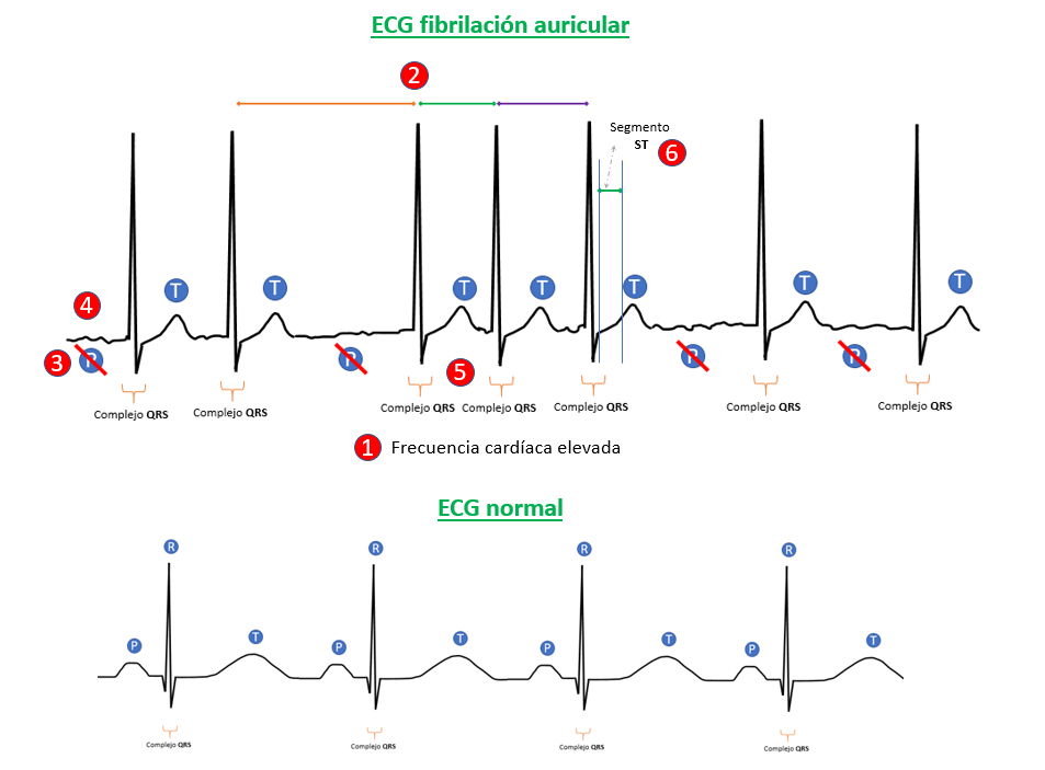 ECG De La Fibrilaci n Auricular Explicaci n Sencilla
